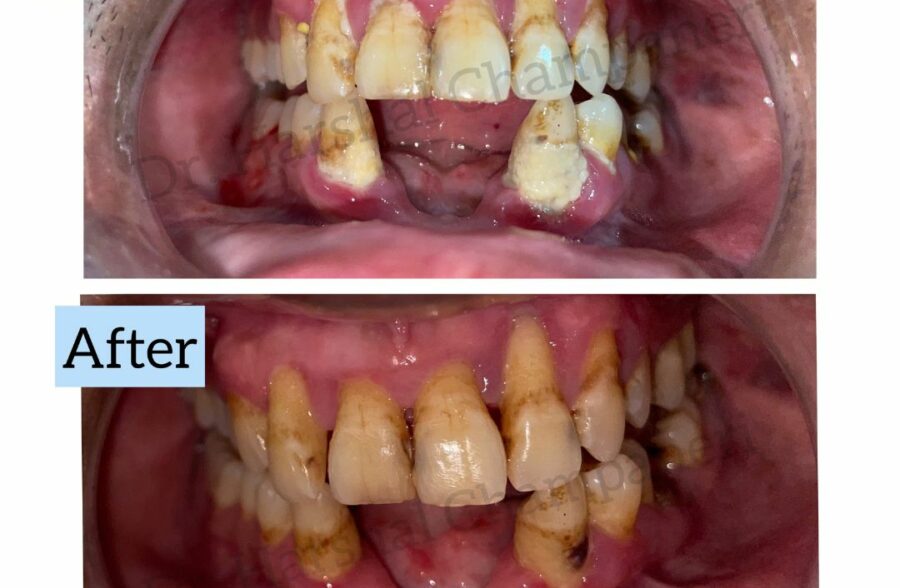 Before-after | 20 – Dr. Harshal's Dental Implant & Pyorrhea Centre