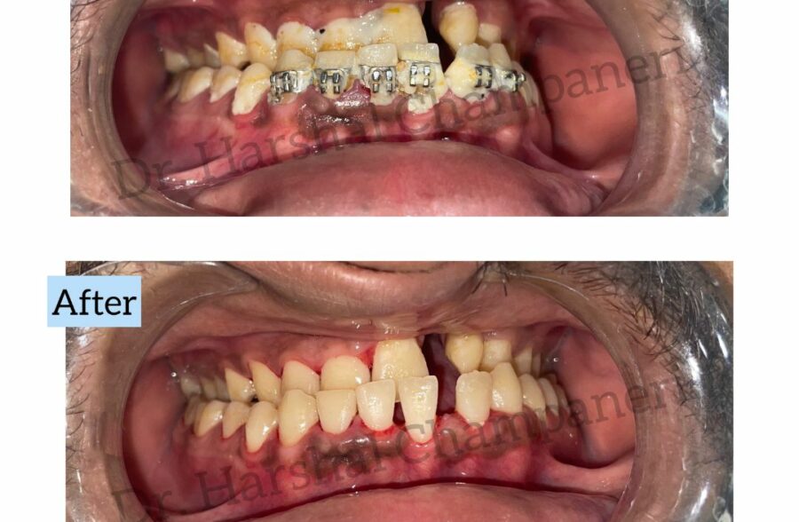 Before-after | 25 – Dr. Harshal's Dental Implant & Pyorrhea Centre